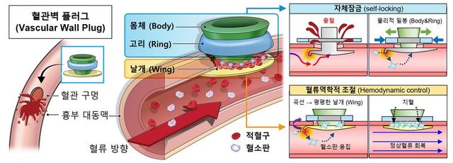 Revolutionary Vascular Wall Plug: How This New Device Enhances Blood ...